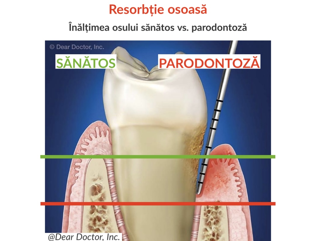 Ce este parodontoza? #sfatulparodontologului – DENTALDiM Pro Clinica